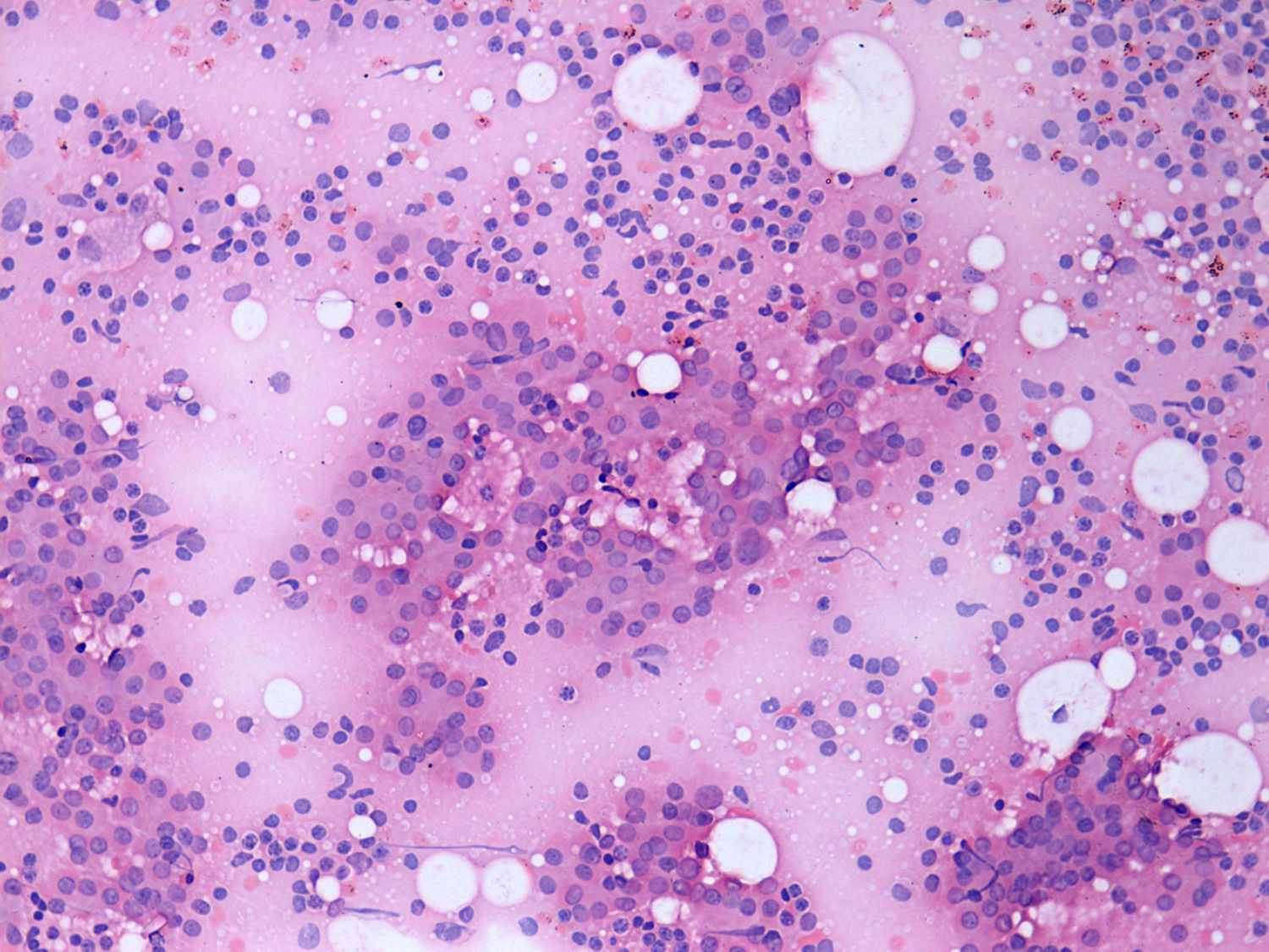 Chronic Thyroiditis chronic-thyroiditis
