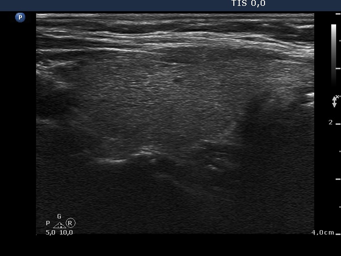 Lessons: The judgement of the basic echostructure of the thyroid