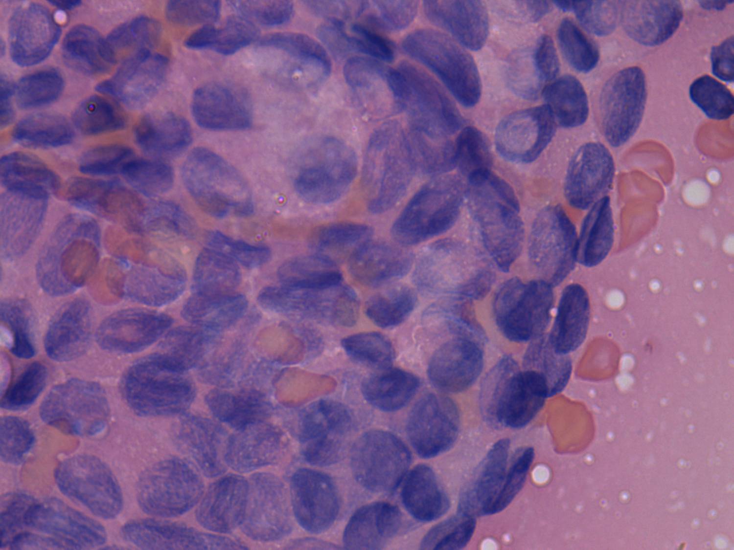 Papillary cancer