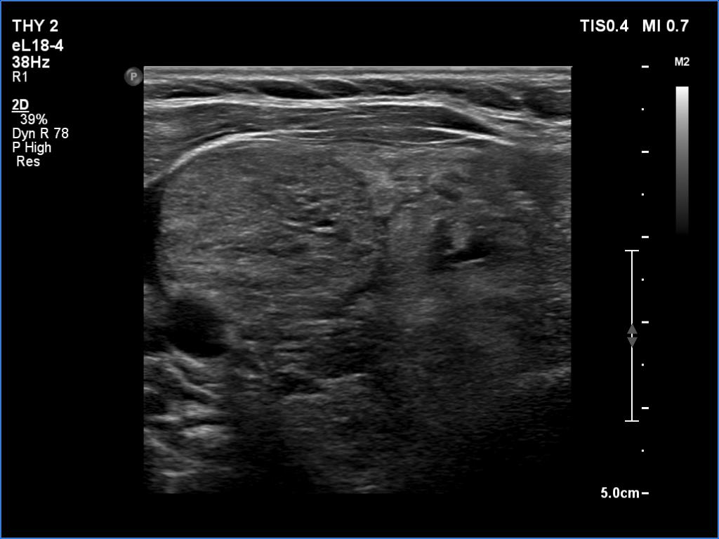 Multinodular Goiter Ultrasound Goiter: Nontoxic Thyroid Gland