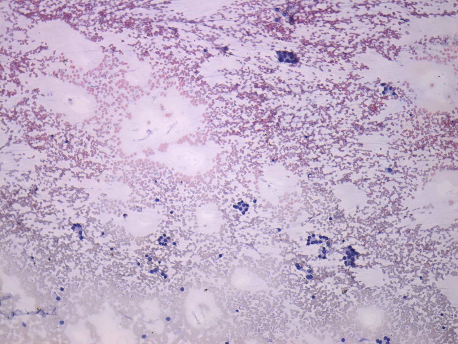 Follicular adenoma
